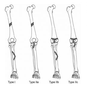 Floating Knee - ORTHOPODS INDONESIA